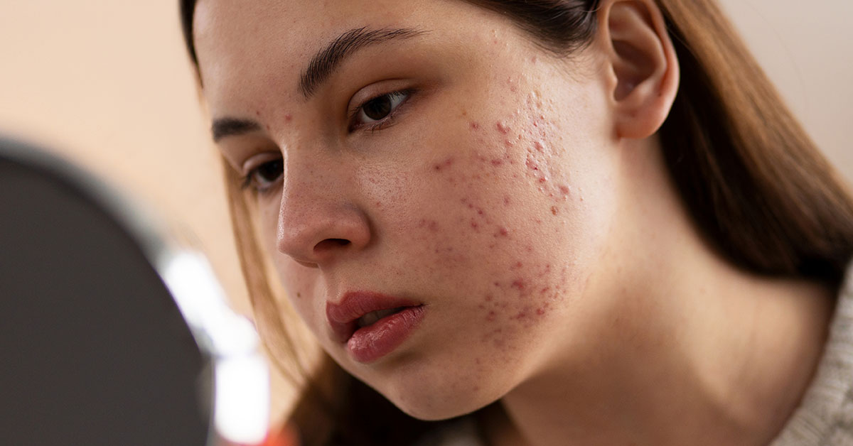 Como a Dermatologia Estética trata a acne e suas marcas?